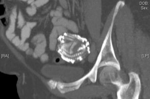 A Moroccan woman gives birth to a "stone baby" after 46 year pregnancy