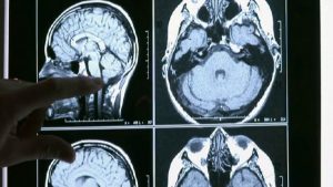 The Five Siblings of Ulas Family Who Walk on All Fours