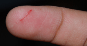 Why Does a Paper Cut Hurt So Much?