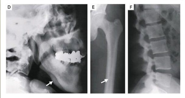 This Gene Mutation Causes Abnormally Dense Bones that Never Fracture
