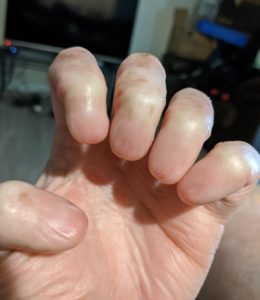 Anonychia – a Condition Marked by an Absence of Fingernails