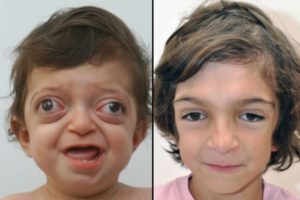 Crouzon Syndrome Patients Benefit Through Plastic Corrections