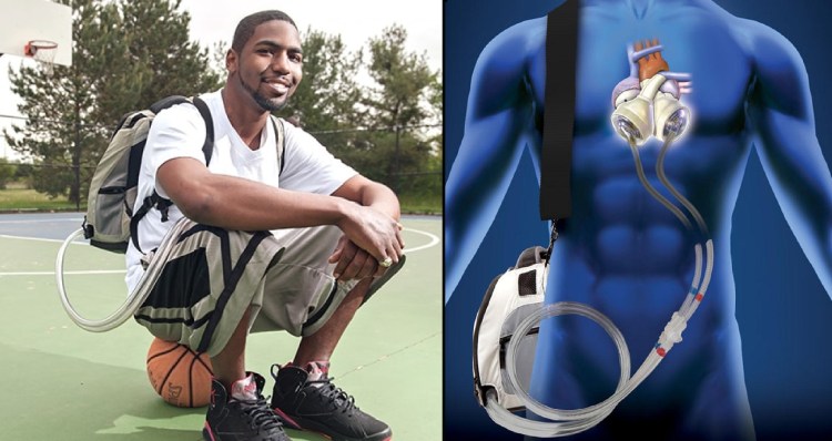 Stan Larkin, The Man Who Lived for 555 Days Without a Heart